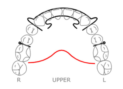 Anterior Aligners | Olympic Ortho Lab